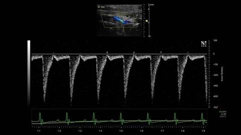 Pulsed-Wave Doppler | FUJIFILM VisualSonics