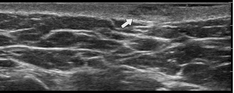 Scar - Conventional vs. Ultra High Frequency | FUJIFILM VisualSonics