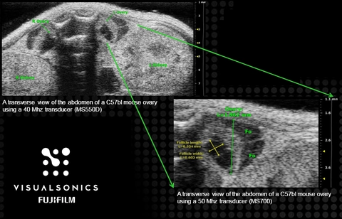 Ovarian Cancer Ultrasound